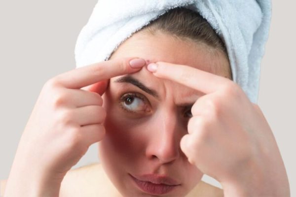 What Are The Symptoms, Causes, Treatment, And Tips For Comedonal Acne ...