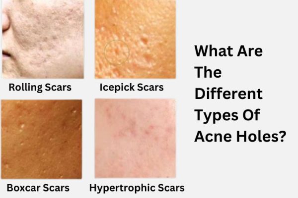 What Is Acne Holes On Face: Types, Treatment, and Prevention Tips ...